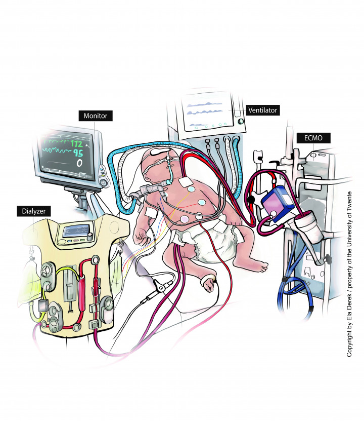 Artificial placenta to save babies’ lives - U-Today